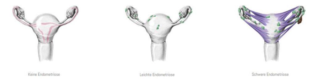 Was ist Endometriose? Eine Betroffene erklärt es dir!